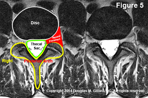 Thecal Sac Mri Axial